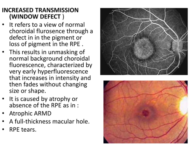 Fundus fl. angio | PPTX | Eye and Vision Conditions | Diseases and ...