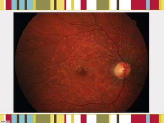 Fundus flavimaculatus | PPTX
