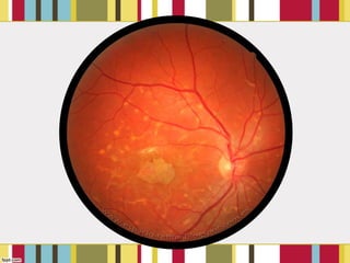 Fundus flavimaculatus | PPTX