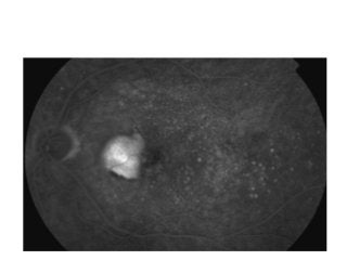 Fundus Flourescein Angiography( FFA ) by optometry fans.pptx