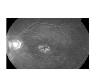 Fundus Flourescein Angiography( FFA ) by optometry fans.pptx