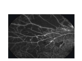 Fundus Flourescein Angiography( FFA ) by optometry fans.pptx