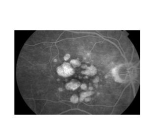 Fundus Flourescein Angiography( FFA ) by optometry fans.pptx