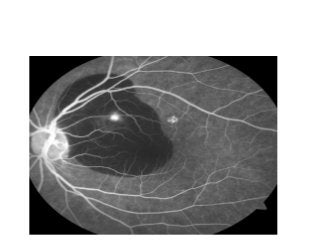 Fundus Flourescein Angiography( FFA ) by optometry fans.pptx