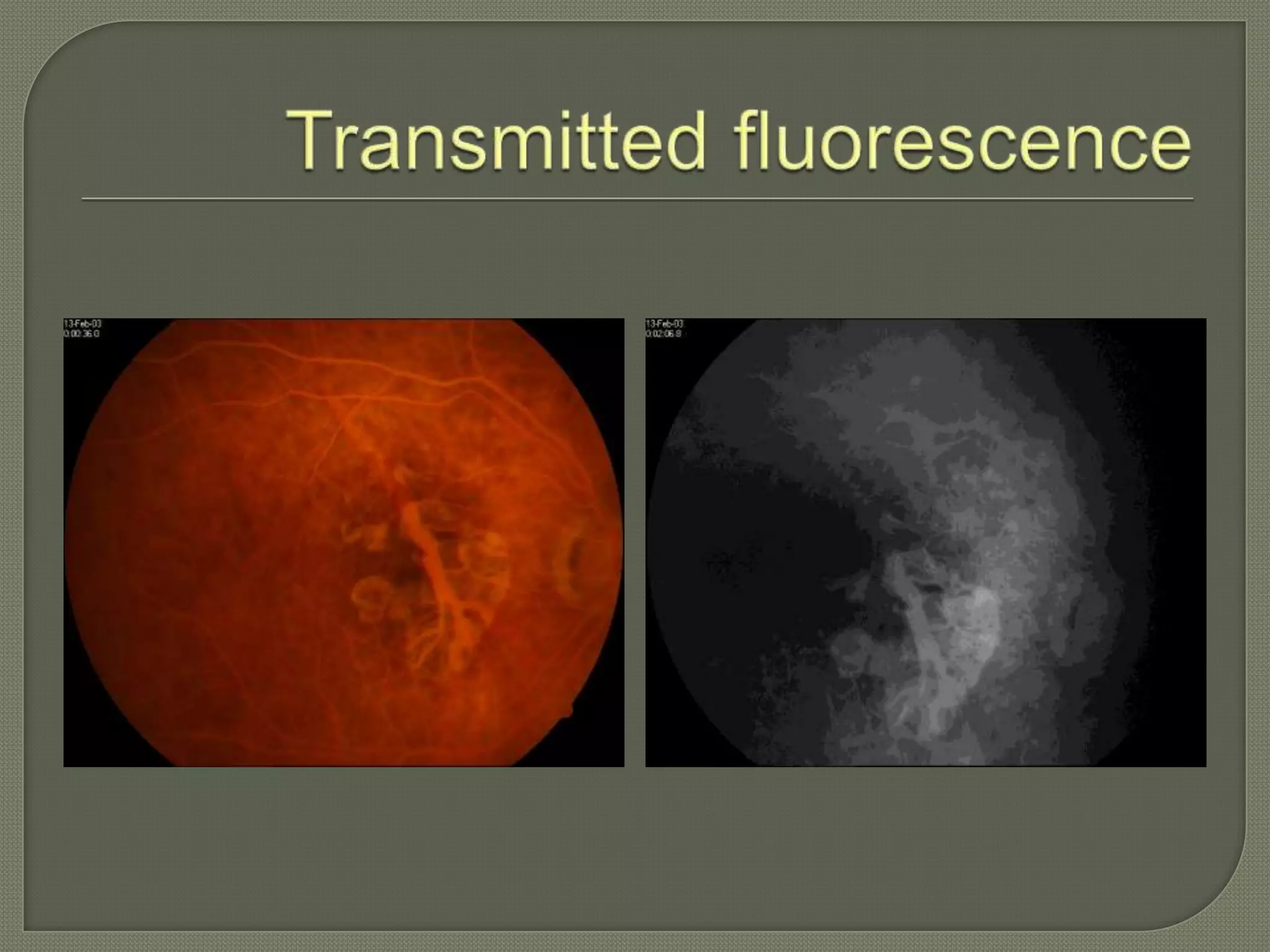 Fundus fluorescein angiography | PPTX