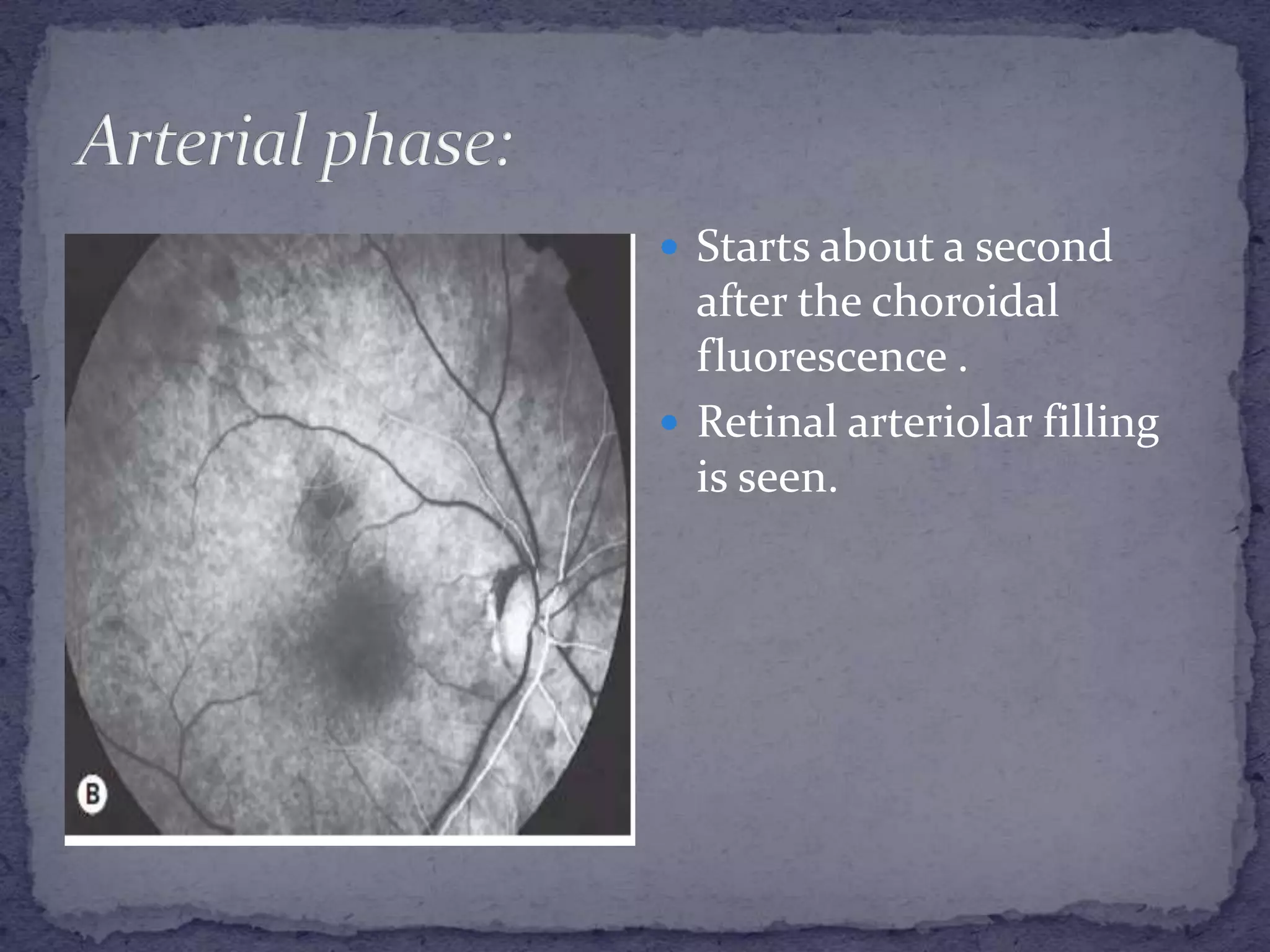 Fundus fluorescein angiography of retina | PPTX