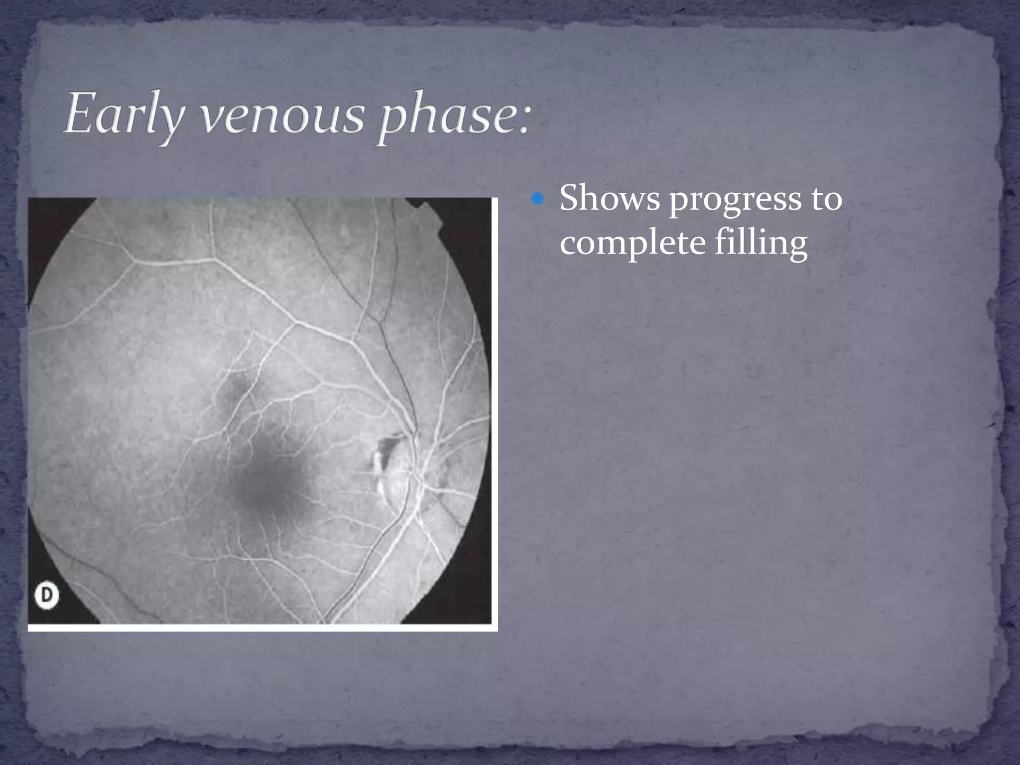 Fundus fluorescein angiography of retina | PPTX