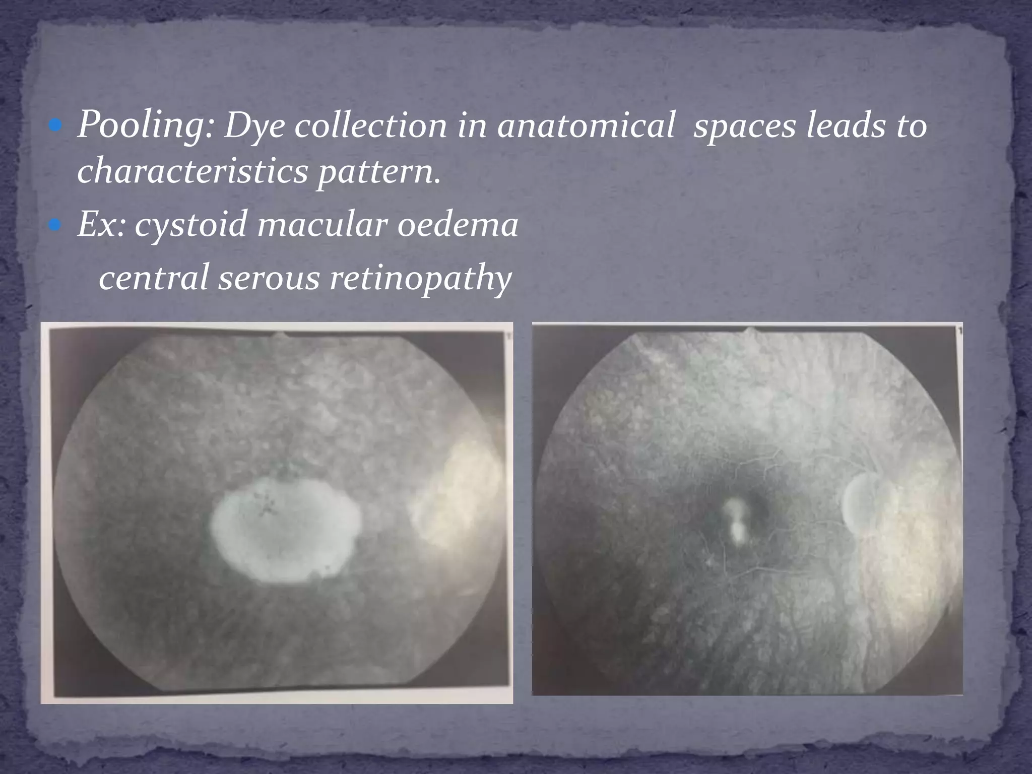 Fundus fluorescein angiography of retina | PPTX