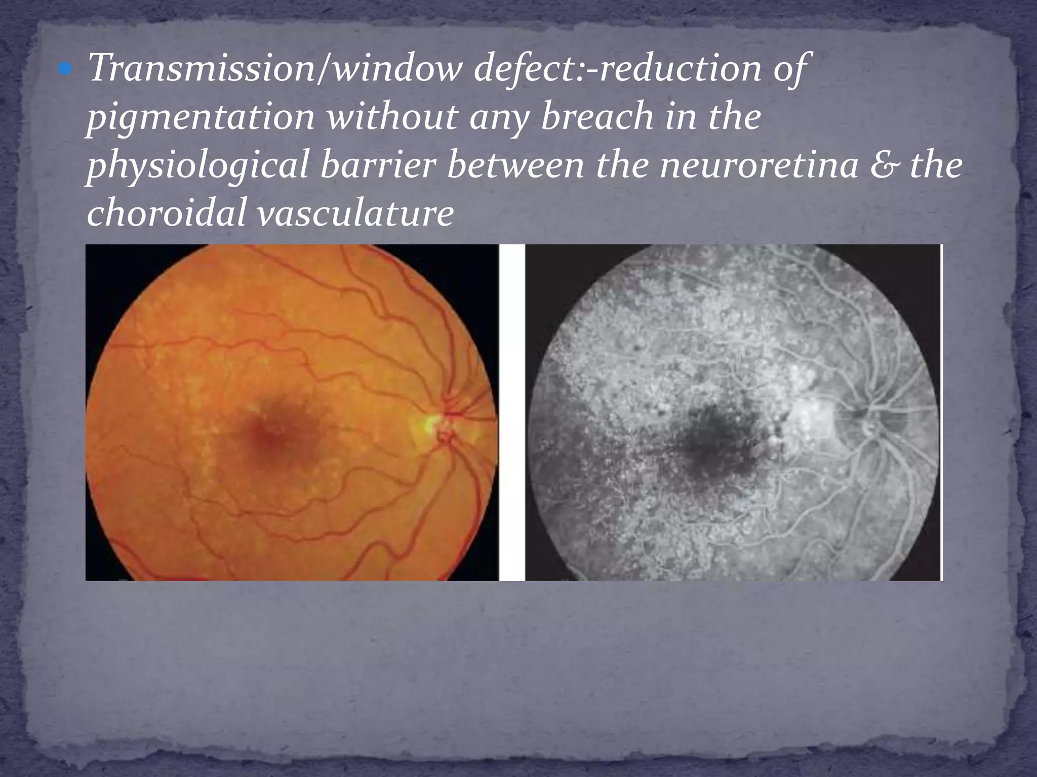Fundus fluorescein angiography of retina | PPTX