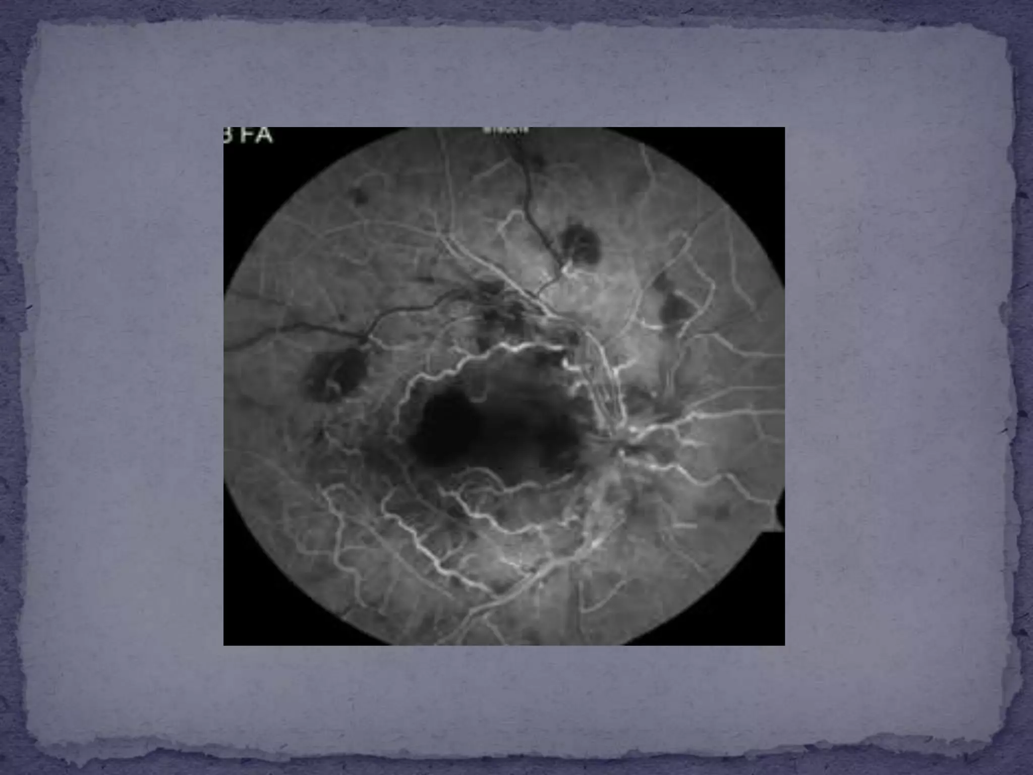 Fundus fluorescein angiography of retina | PPTX