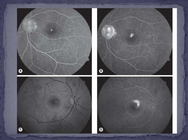 Fundus fluorescein angiography of retina | PPTX