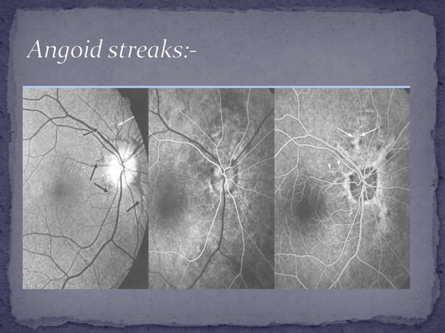 Fundus fluorescein angiography of retina | PPTX