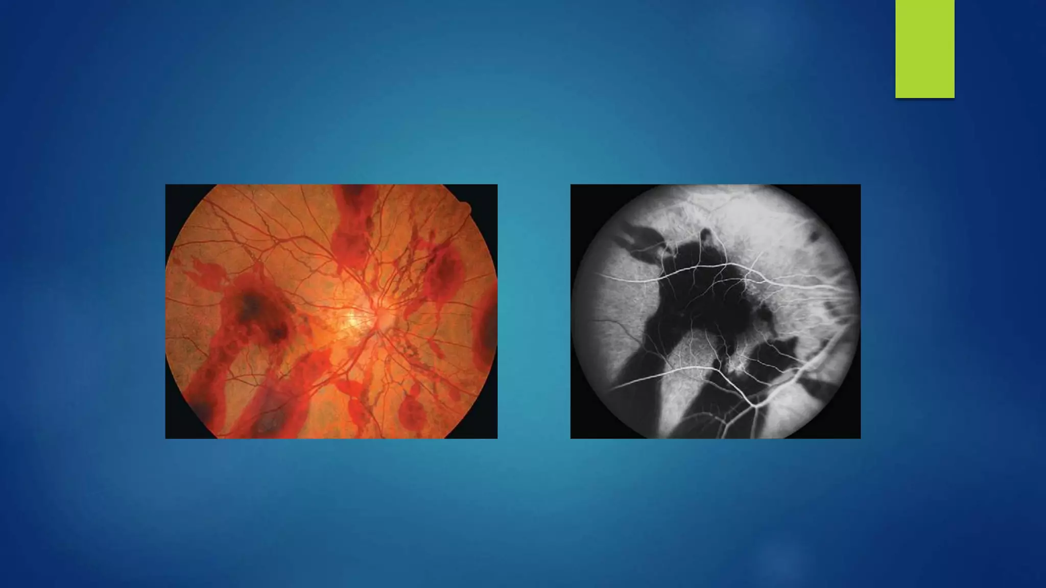 Fundus fluorescein angiography | PPTX