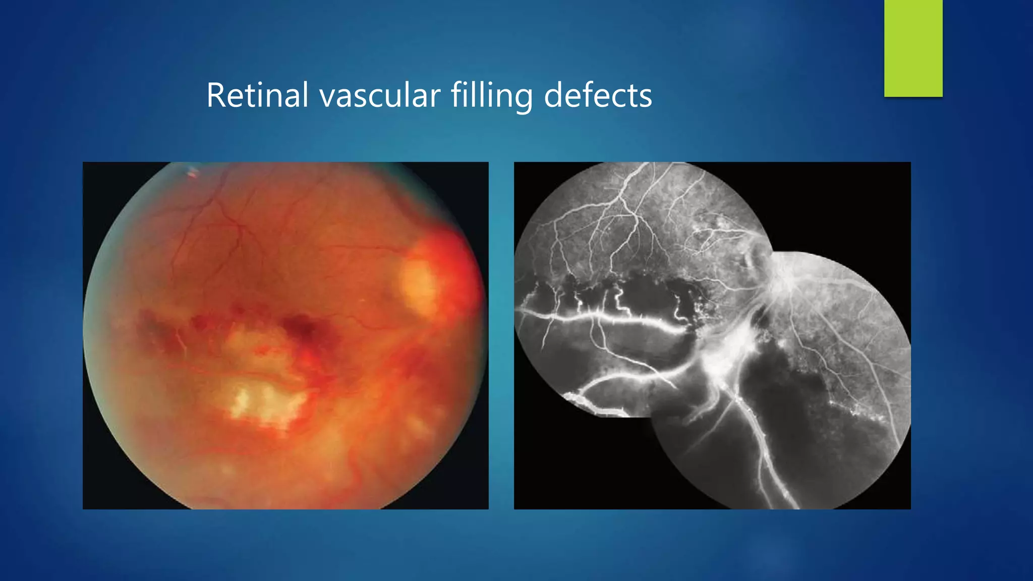 Fundus fluorescein angiography | PPTX