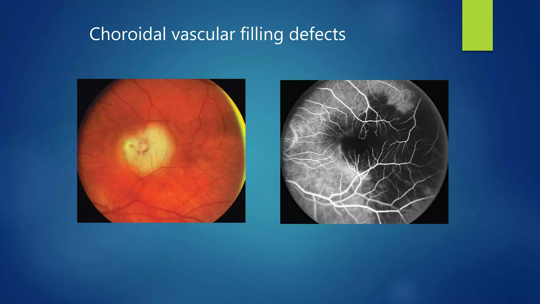 Fundus fluorescein angiography | PPTX