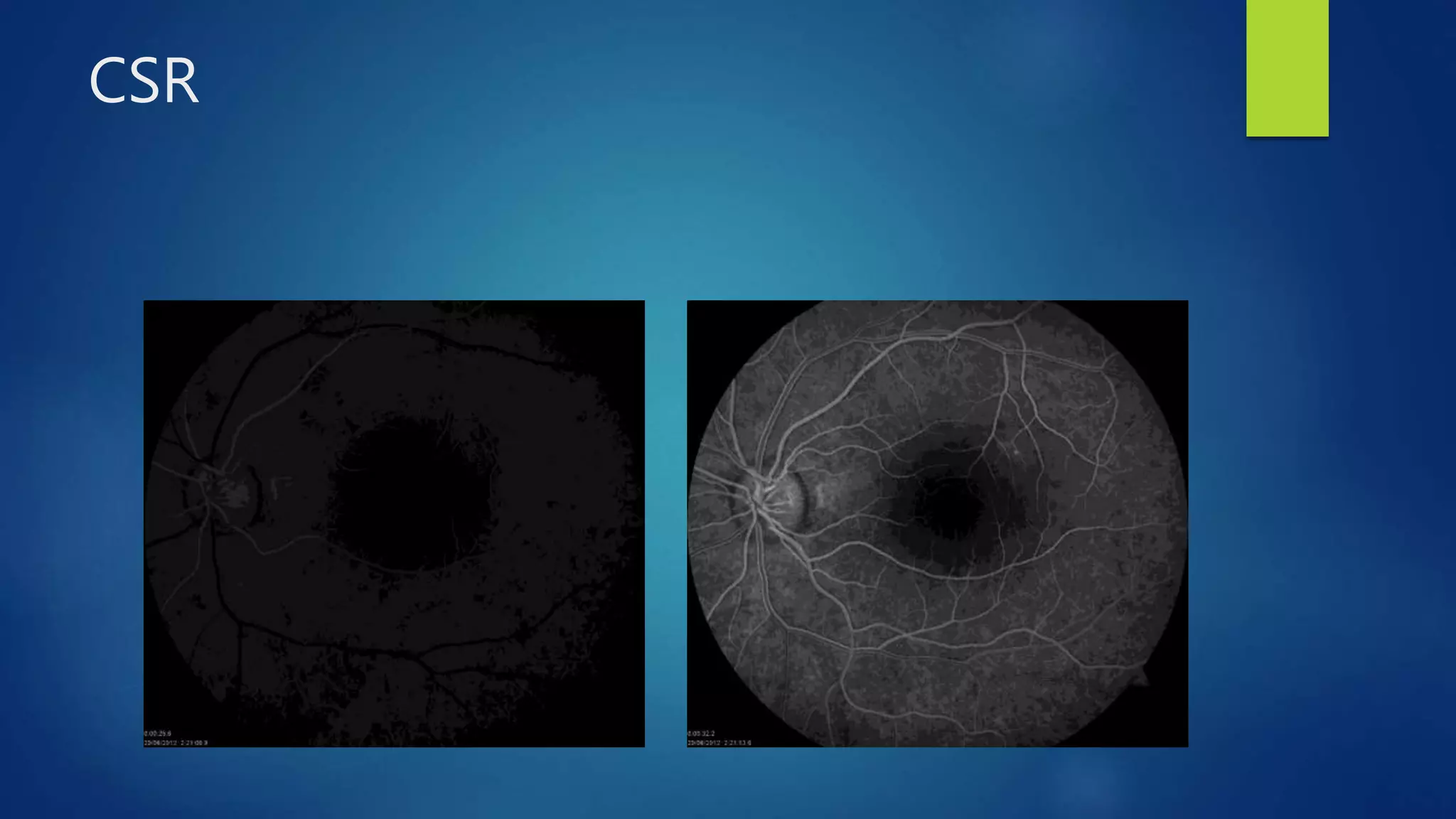 Fundus fluorescein angiography | PPTX
