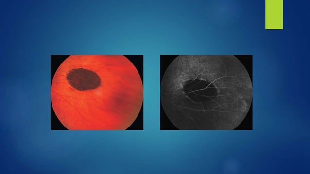 Fundus fluorescein angiography | PPTX | Eye and Vision Conditions ...