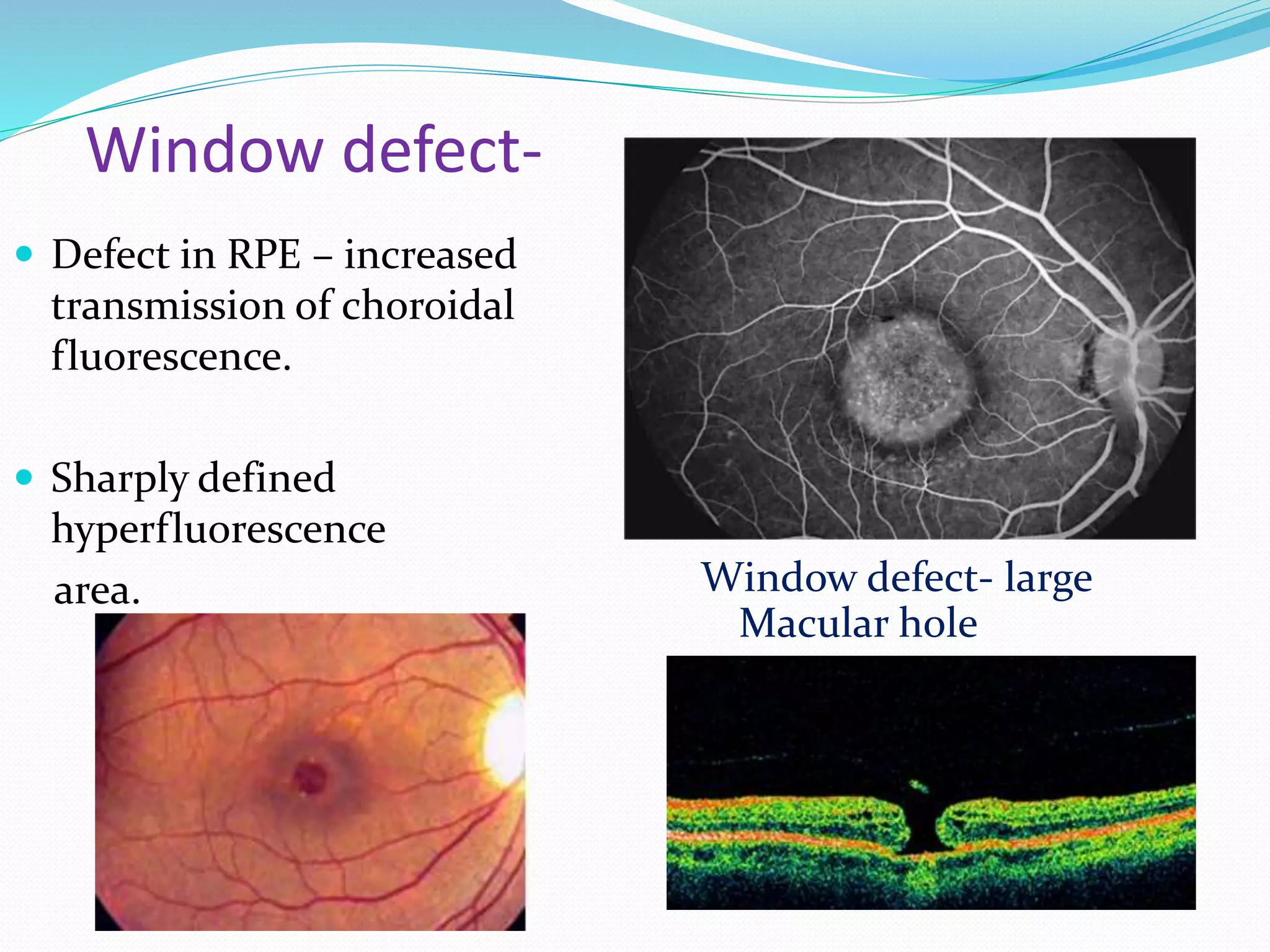 Fundus fluorescein angiography and B-scan by vijay | PPTX