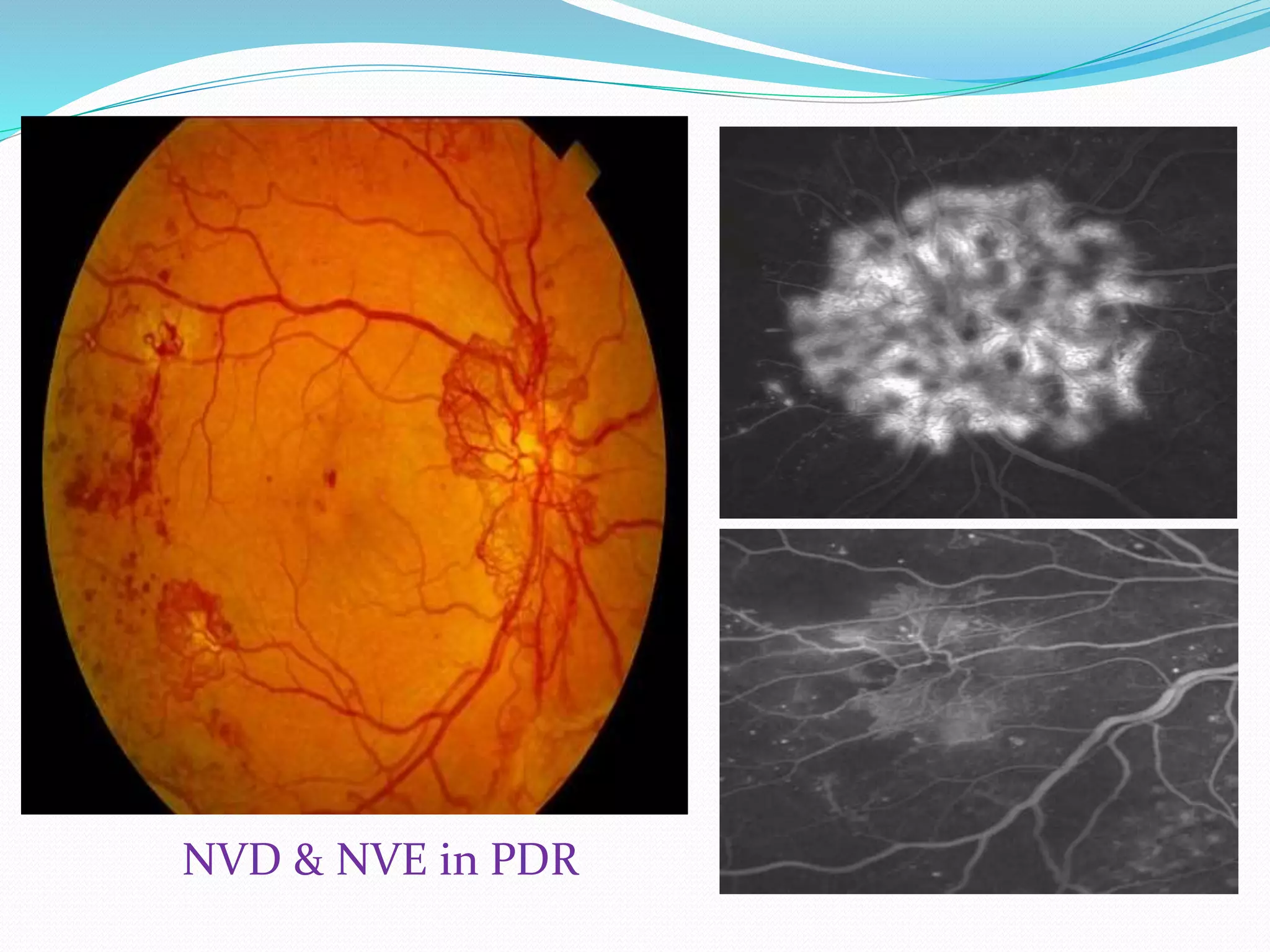 Fundus fluorescein angiography and B-scan by vijay | PPTX
