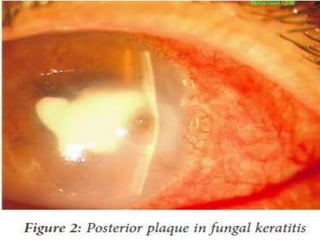 Fungal corneal ulcer | PPTX