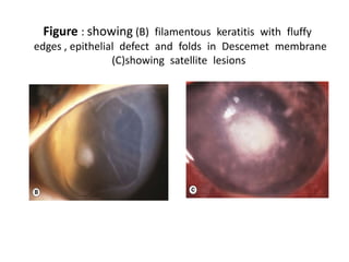 Fungal corneal-ulcer-final | PPTX