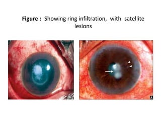 Fungal corneal-ulcer-final | PPTX