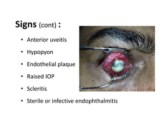Fungal corneal-ulcer-final | PPTX