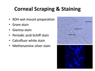 Fungal corneal-ulcer-final | PPTX