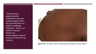 Fungal-Infections.pptx- fungal infections a lecture for students | PPTX