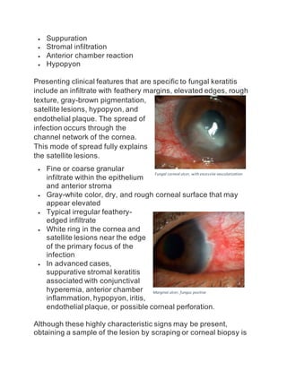 Fungal corneal ulcer - | PDF