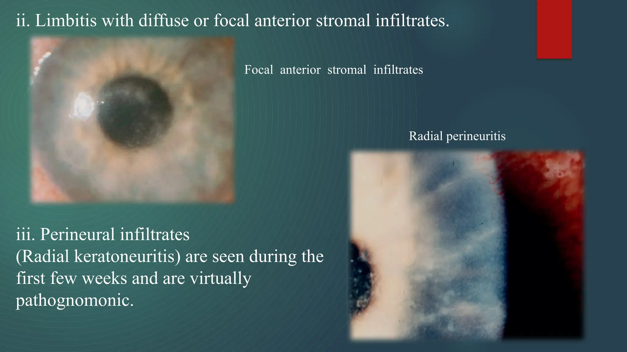 fungal corneal ulcer and protozoal keratitis.pptx