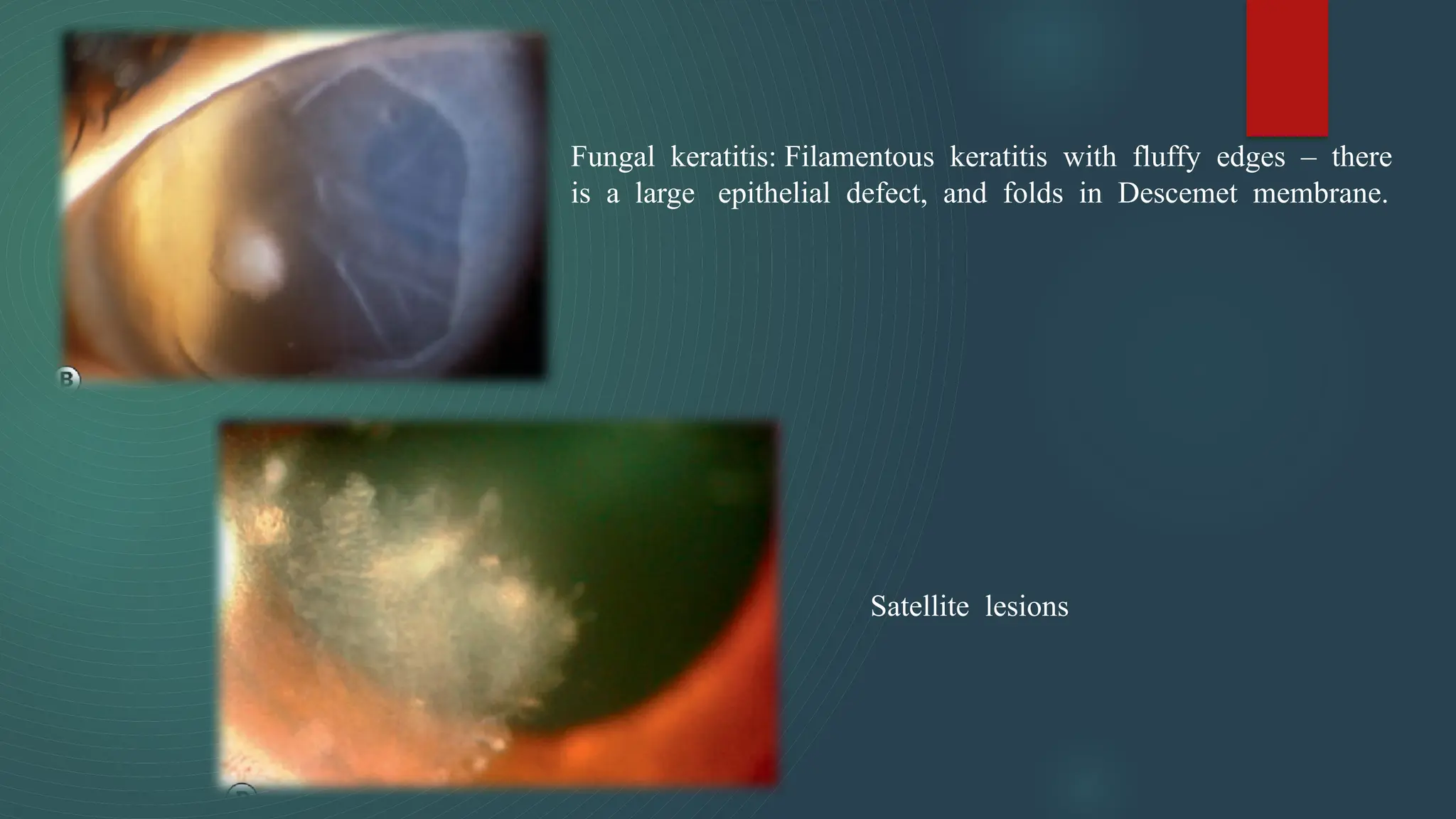 fungal corneal ulcer and protozoal keratitis.pptx