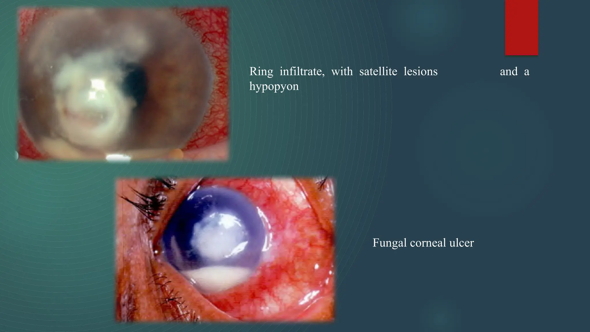 fungal corneal ulcer and protozoal keratitis.pptx