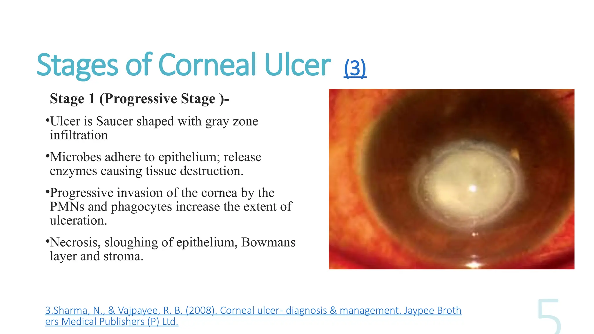 Fungal corneal ulcers- Detailed overview | PPTX
