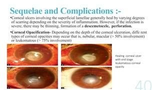 Fungal corneal ulcers- Detailed overview | PPTX