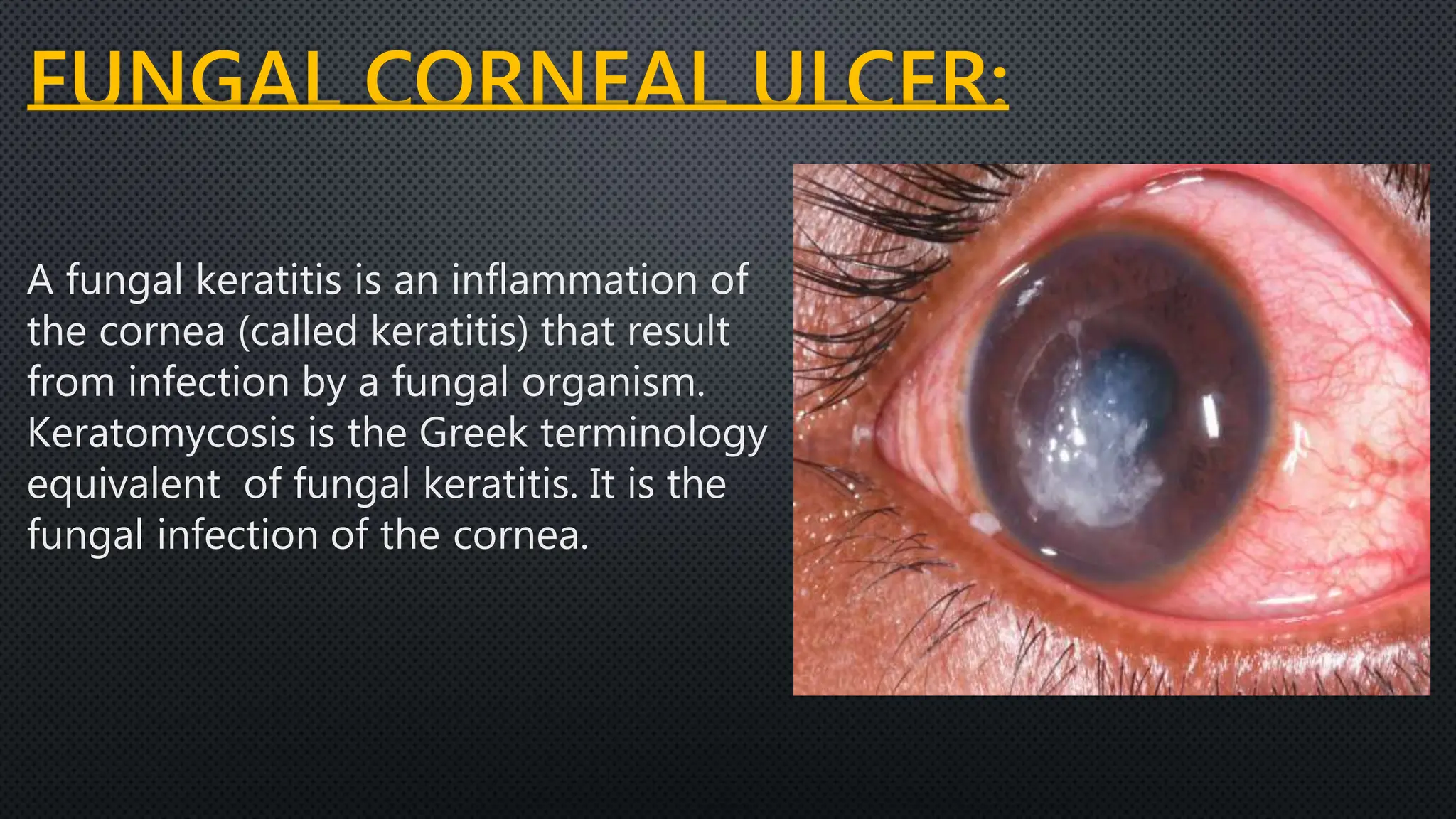 Fungal Corneal Ulcer Ophthalmology PPT.pptx