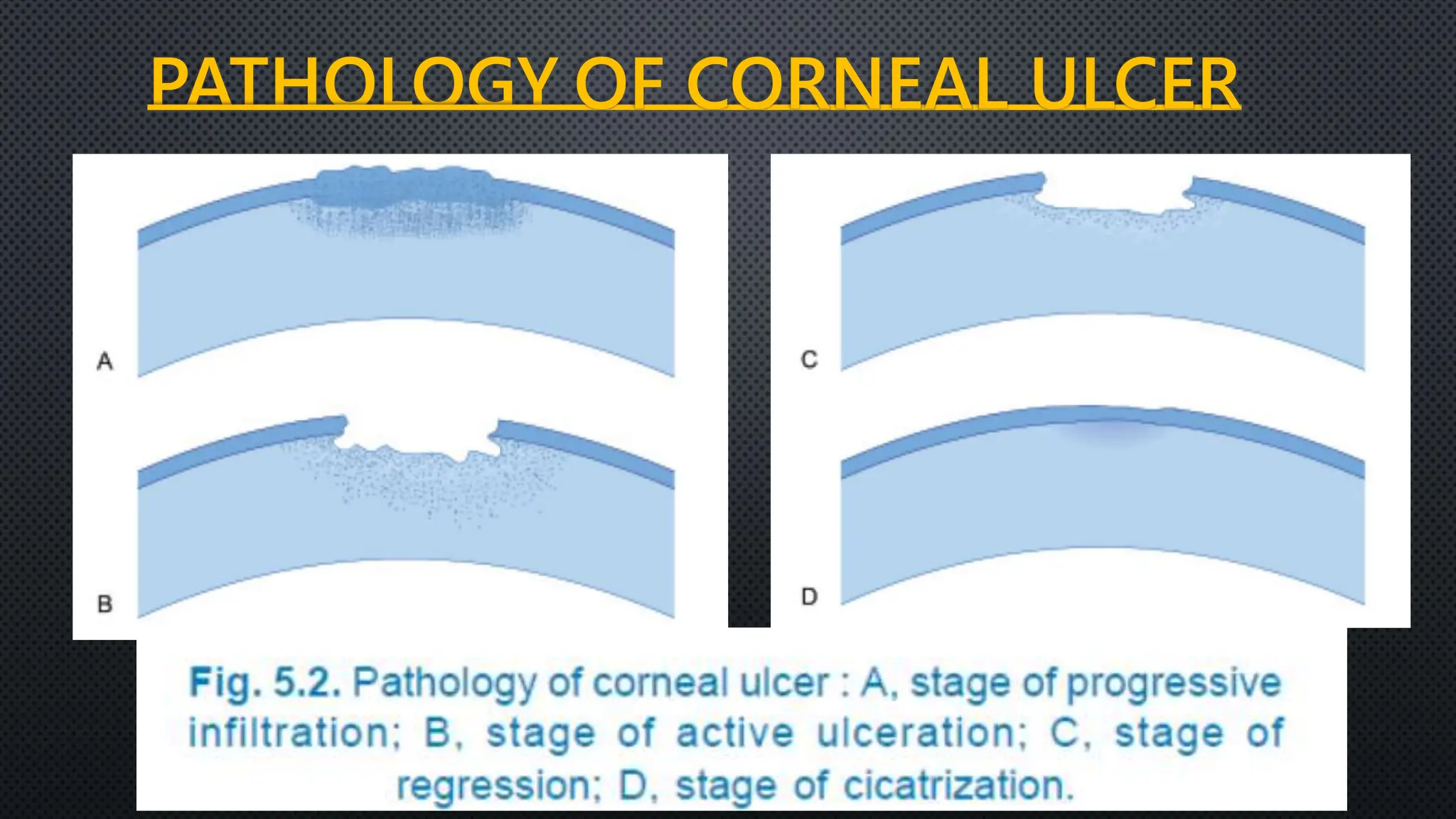 Fungal Corneal Ulcer Ophthalmology PPT.pptx