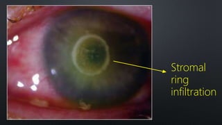 Fungal Corneal Ulcer Ophthalmology PPT.pptx