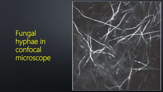 Fungal Corneal Ulcer Ophthalmology PPT.pptx