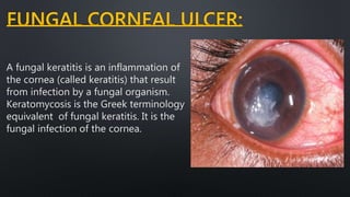 Fungal Corneal Ulcer Ophthalmology PPT.pptx