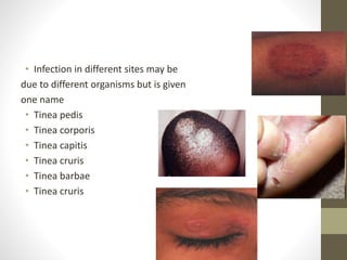 fungal disease of medical importance.pptx