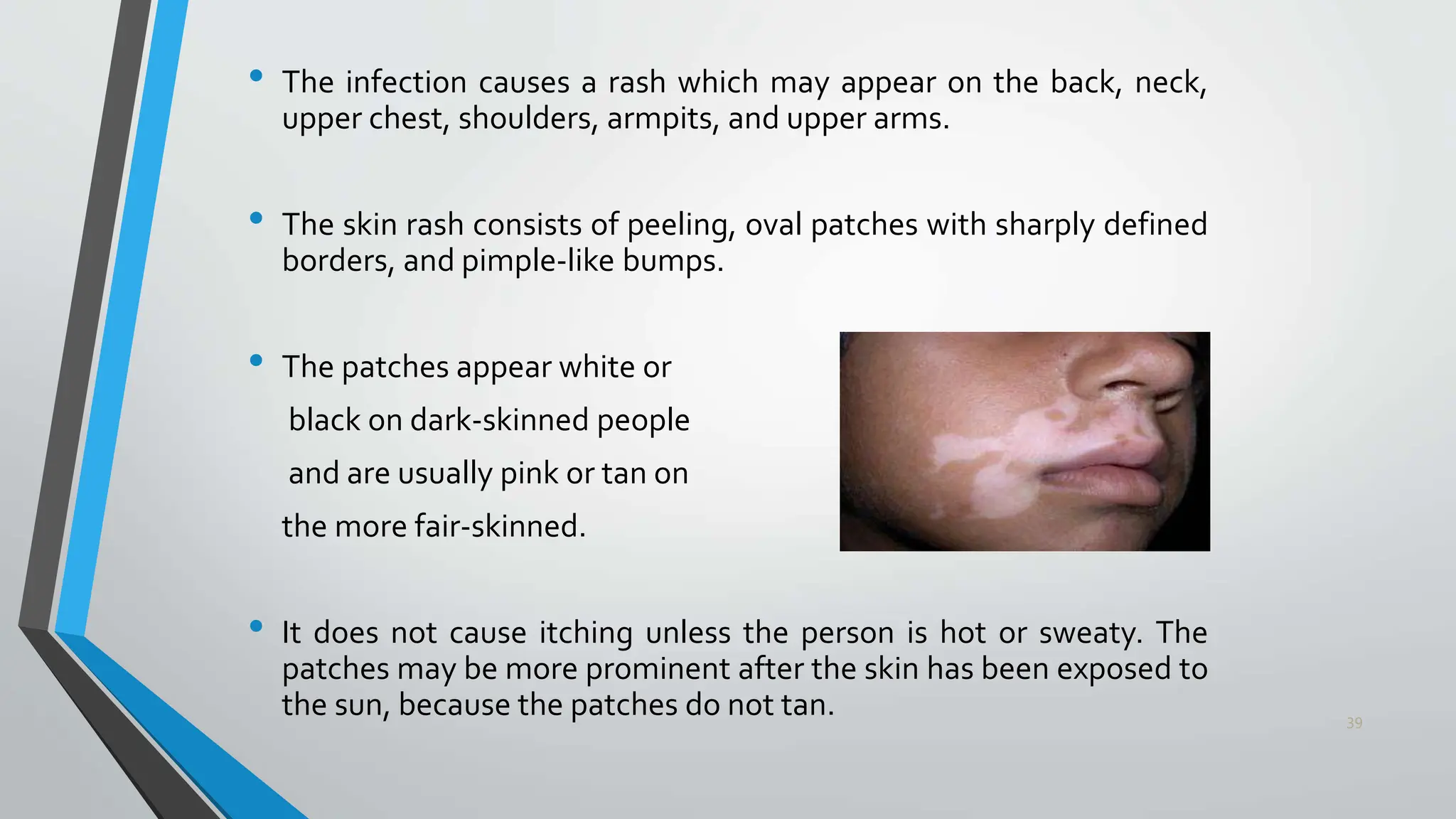 FUNGAL DISEASES in children by dr priyanka.pptx