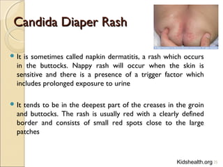 Fungal diseases in children | PPT