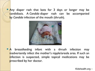 Fungal diseases in children | PPT