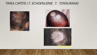 Fungal diseases [penicillium and trichophyton] | PPTX