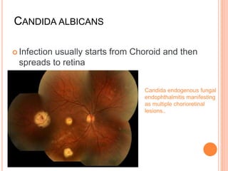 Fungal endophthalmatits | PPTX