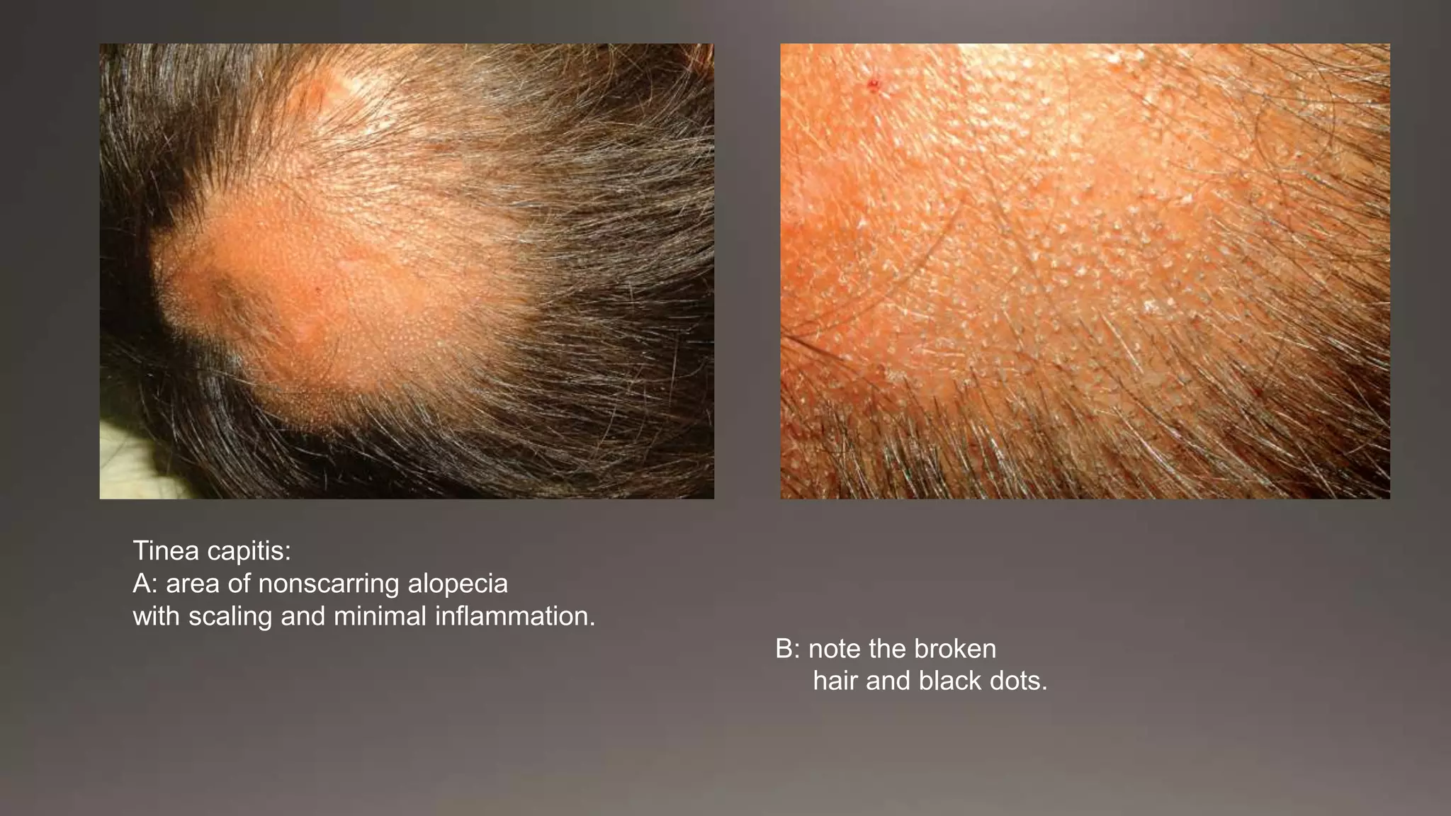 Fungal infection of skin | PPTX