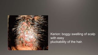 Fungal infection of skin | PPTX