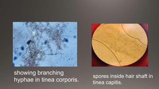 Fungal infection of skin | PPTX
