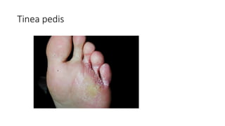 diagnosis and treatment of fungal infection in children .pptx